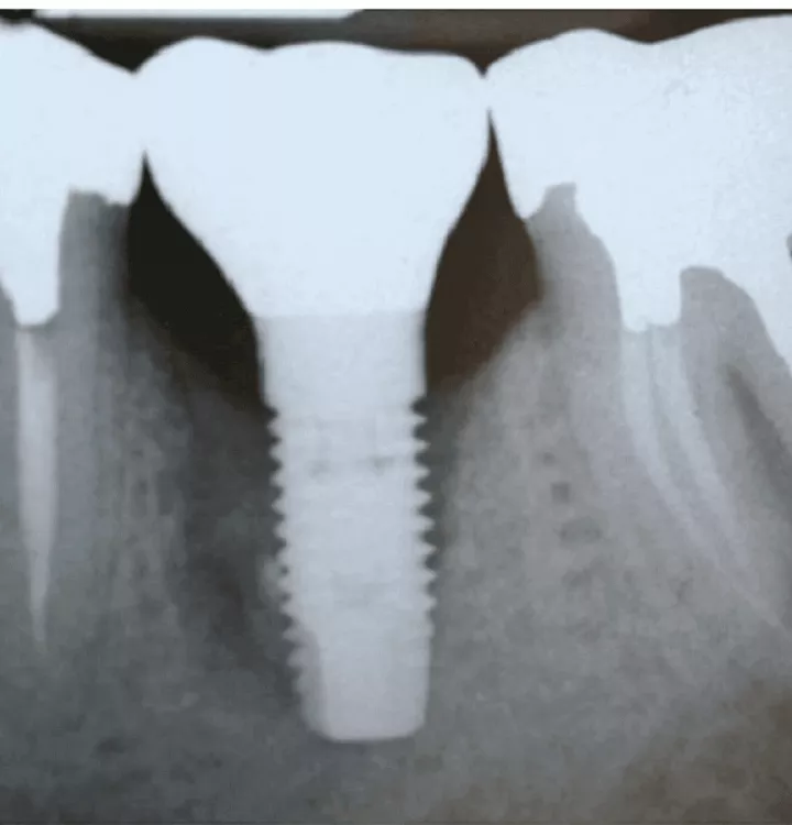 Guidance on the dental crown cementation procedure
