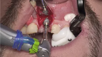 Clinical Cases | Nobel Biocare