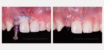 GBR, simultaneous implant placement and soft tissue augmentation in ...