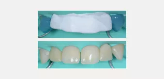 GBR, simultaneous implant placement and soft tissue augmentation in ...