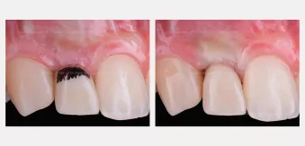 GBR, simultaneous implant placement and soft tissue augmentation in ...