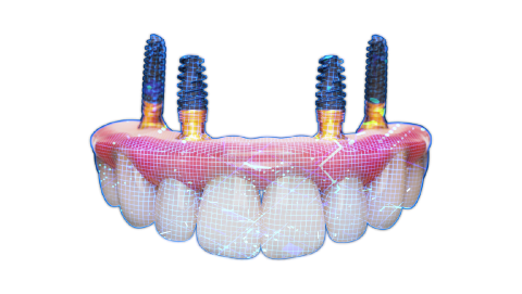 All-on-4® digital workflow | Full-arch rehabilitation