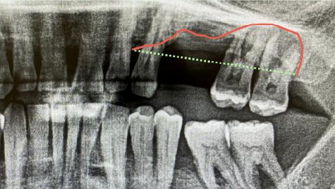 Vertical ridge augmentation in the maxillary posterior region | Nobel ...
