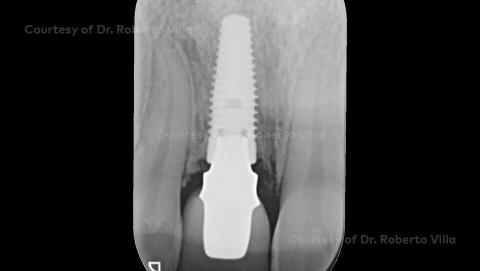7-year follow-up of a central maxillary incisor restoration | Nobel Biocare