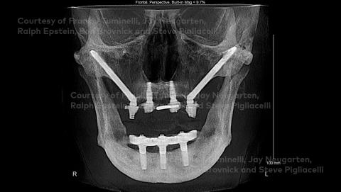 Rehabilitación de un paciente totalmente edéntulo con reabsorción de ...