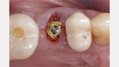 Immediate dental implant placed in a fresh extraction socket