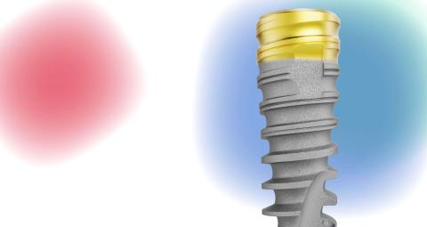 Nobel Biocare N1™ Implant | Nobel Biocare