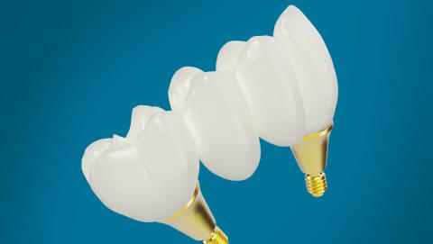 NobelProcera® Zirconia Implant Bridge | Nobel Biocare Canada (EN)